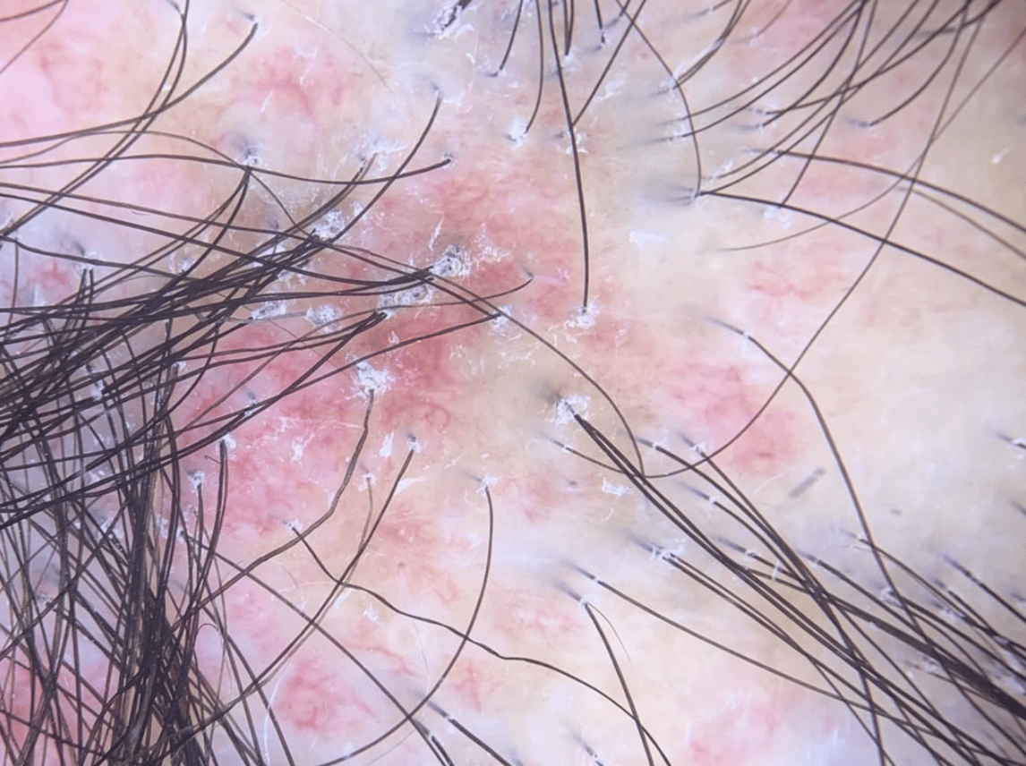 Classic trichoscopic findings of Lichen Planopilaris