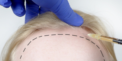 Examining the Potential for Koebnerization and Disease Precipitation in ...