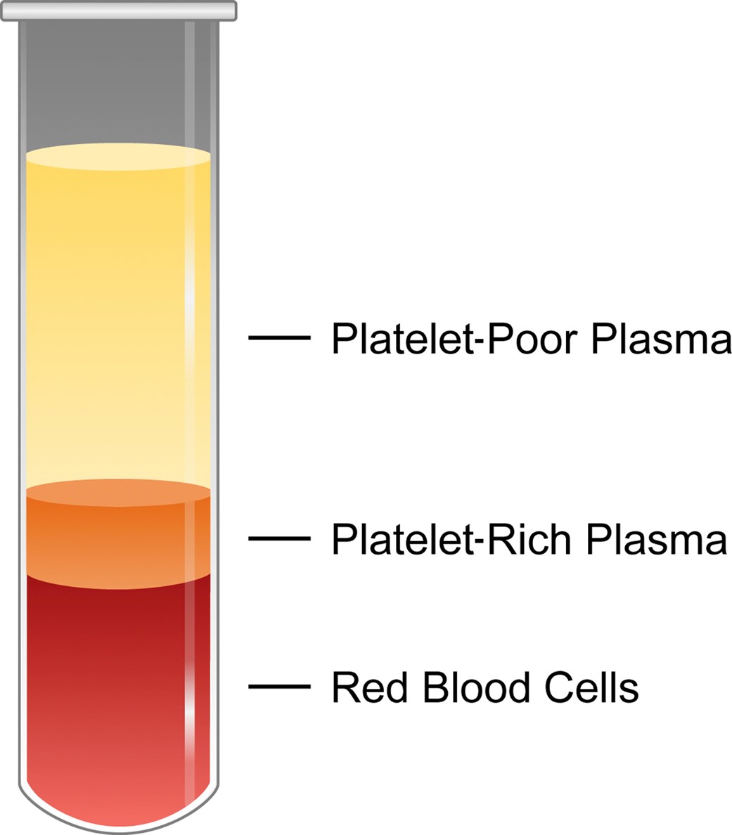 Platelet-rich Plasma in Central Centrifugal Cicatricial Alopecia