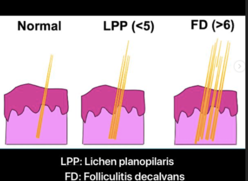 Challenge Case of Compound Follicles – Final Diagnosis Lichen planopilaris